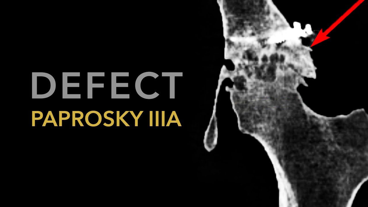 Defect PAPROSKY IIIA - YouTube
