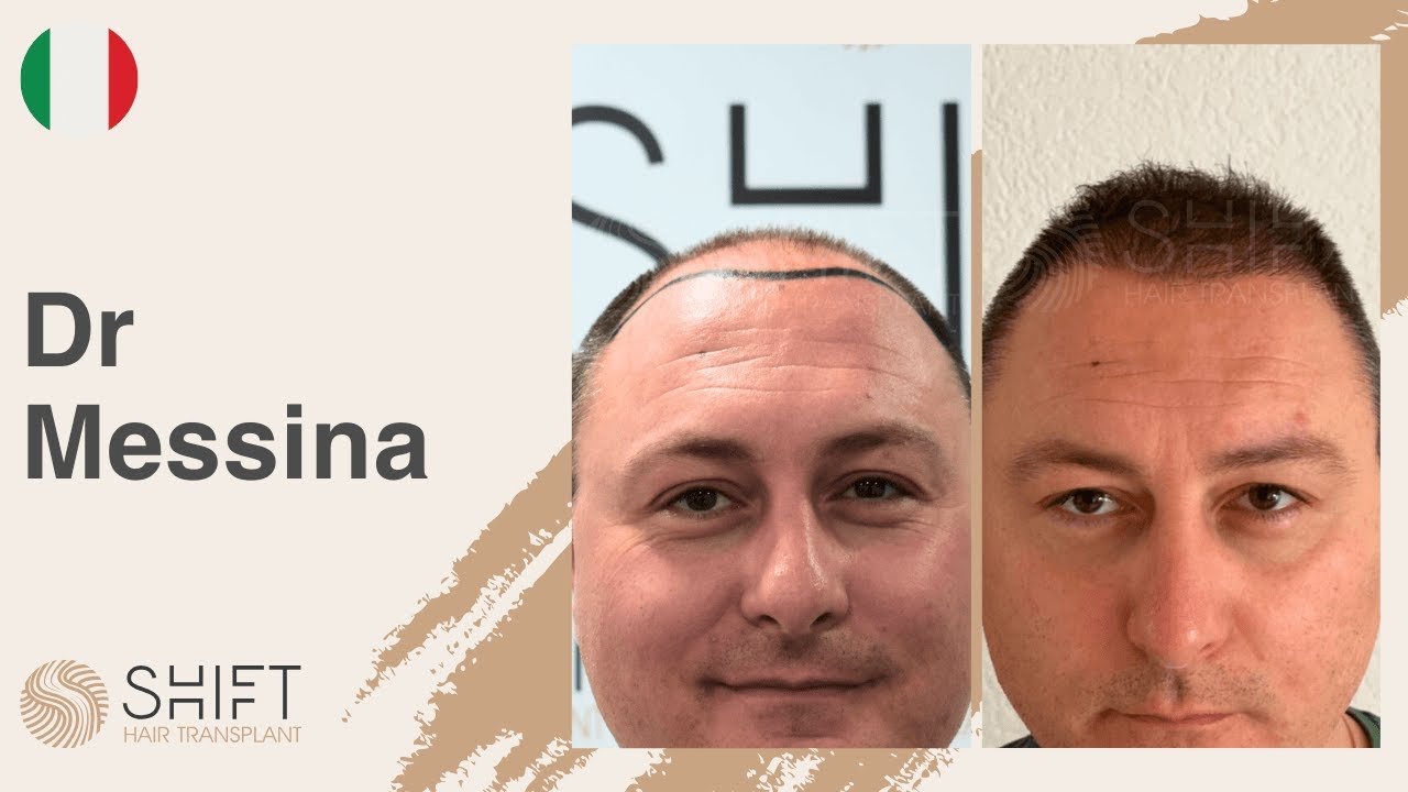 Dr Messina - A Hair Transplant Review with SHIFT Hair in Turkey ...