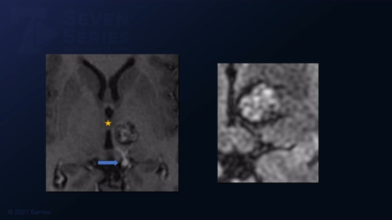 Contralateral Transcallosal-Transchoroidal Approach for a Medial ...