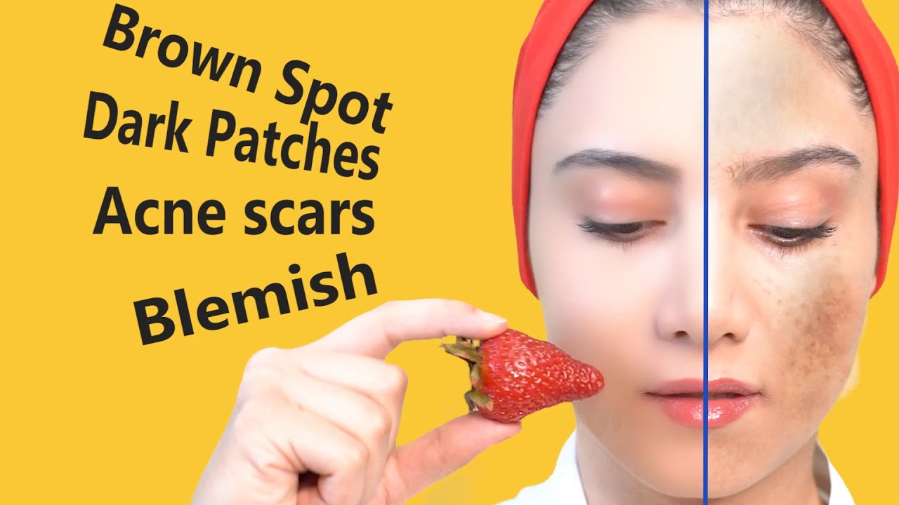Strawberry Mask | Treatment For Dark Spots , Acne Scars And Brown Spots ...