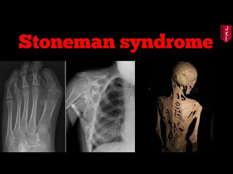 Stone Man Syndrome X Ray