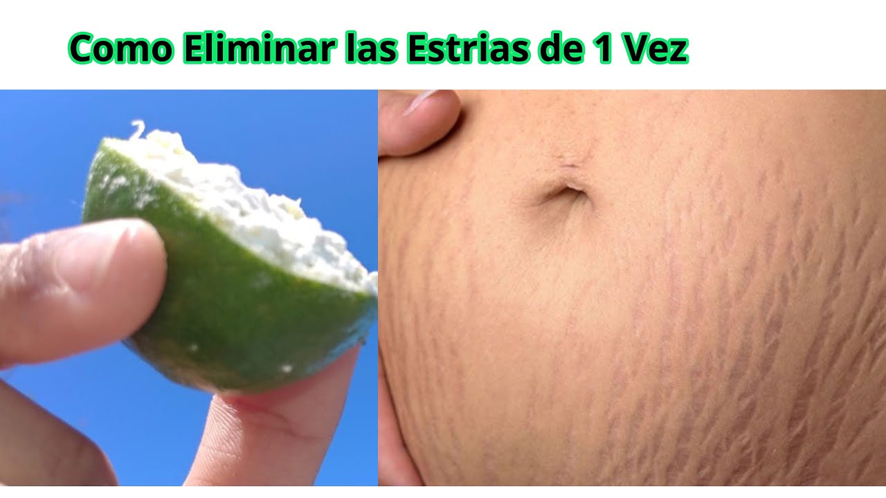 Como Eliminar las Estrías de 1 Vez! Con Este Remedios Natural - YouTube