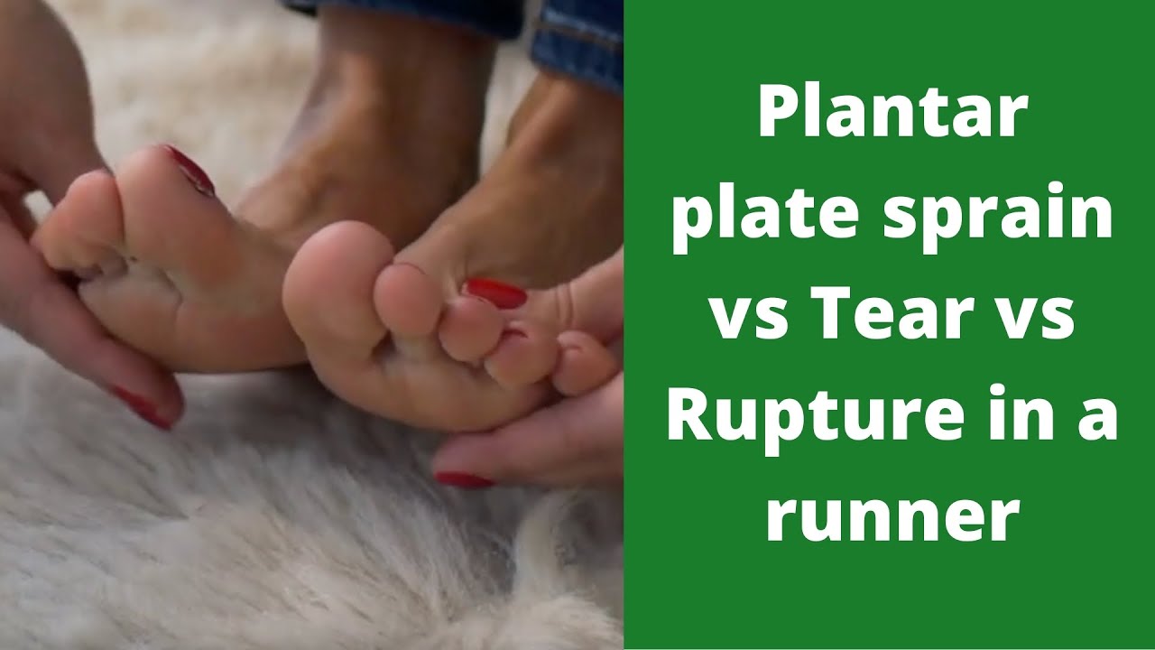 Plantar Plate Sprain vs Tear vs Rupture in a runner - YouTube
