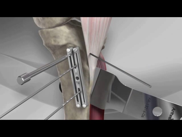 Knee Videos - Dr. Seth L. Sherman Orthopedic Surgeon and Sports Medicine