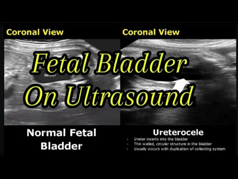 Fetal Bladder Ultrasound Normal Vs Abnormal Images Appearances ...