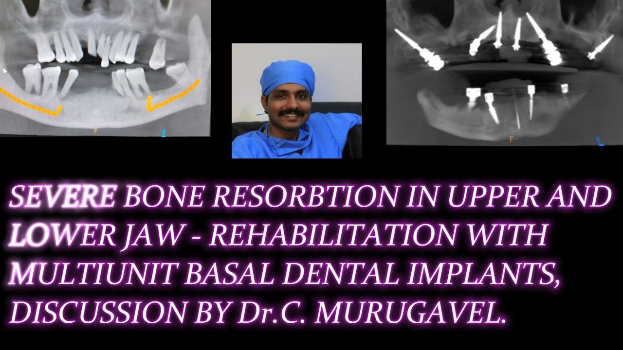 Severe bone Resorption in upper and lower jaw - rehabilitation with ...