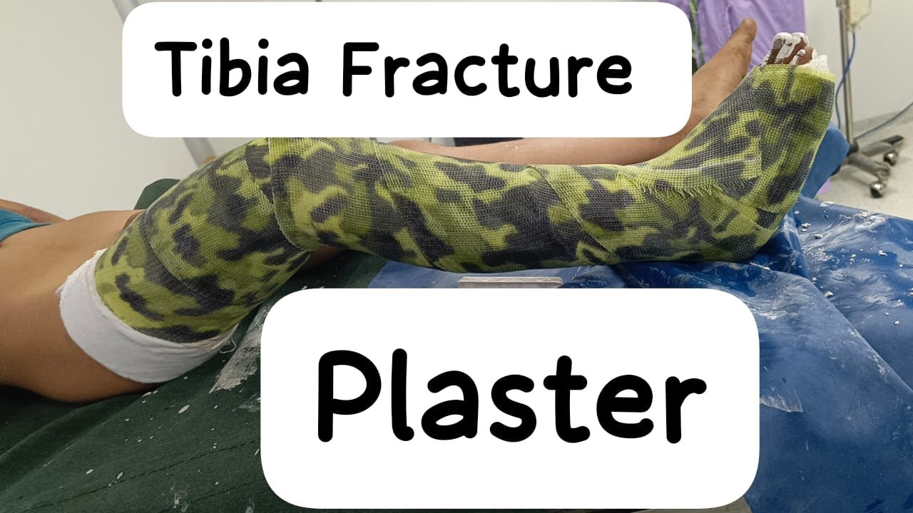 Plaster for Tibia fracture in child | Pediatric leg fracture plaster ...