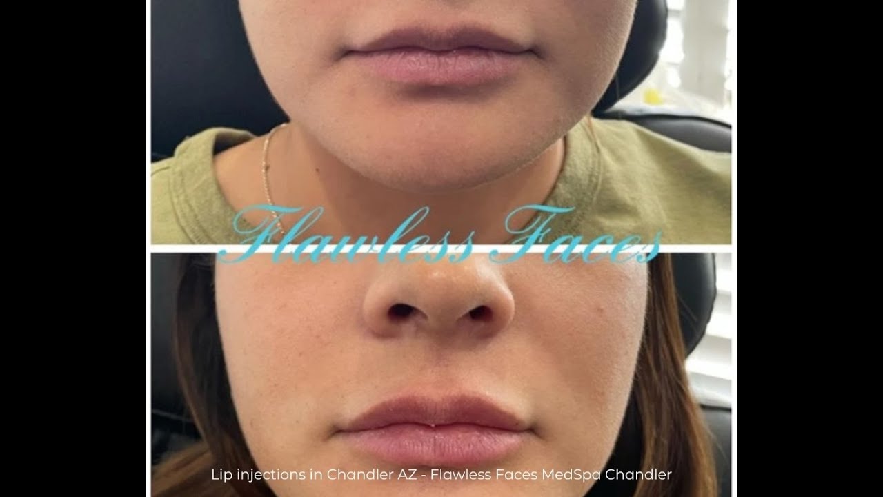 Lip injections in Chandler AZ - Flawless Faces MedSpa Chandler - YouTube