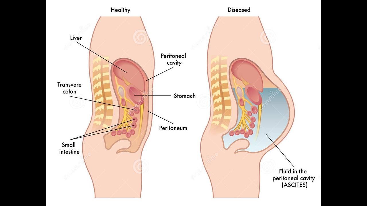 Cours de medecine CAT devant une ascite - YouTube