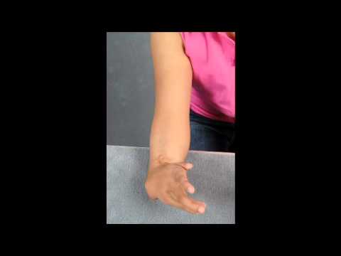 Dr. Charles Goldfarb Discusses Radial Longitudinal Deficiency - YouTube