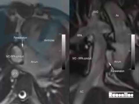MRI of fenestrated Fontan - YouTube