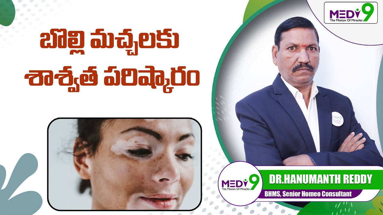 Symptoms of Vitiligo Disease (Bolli Machalu) & Treatment |White Patches ...