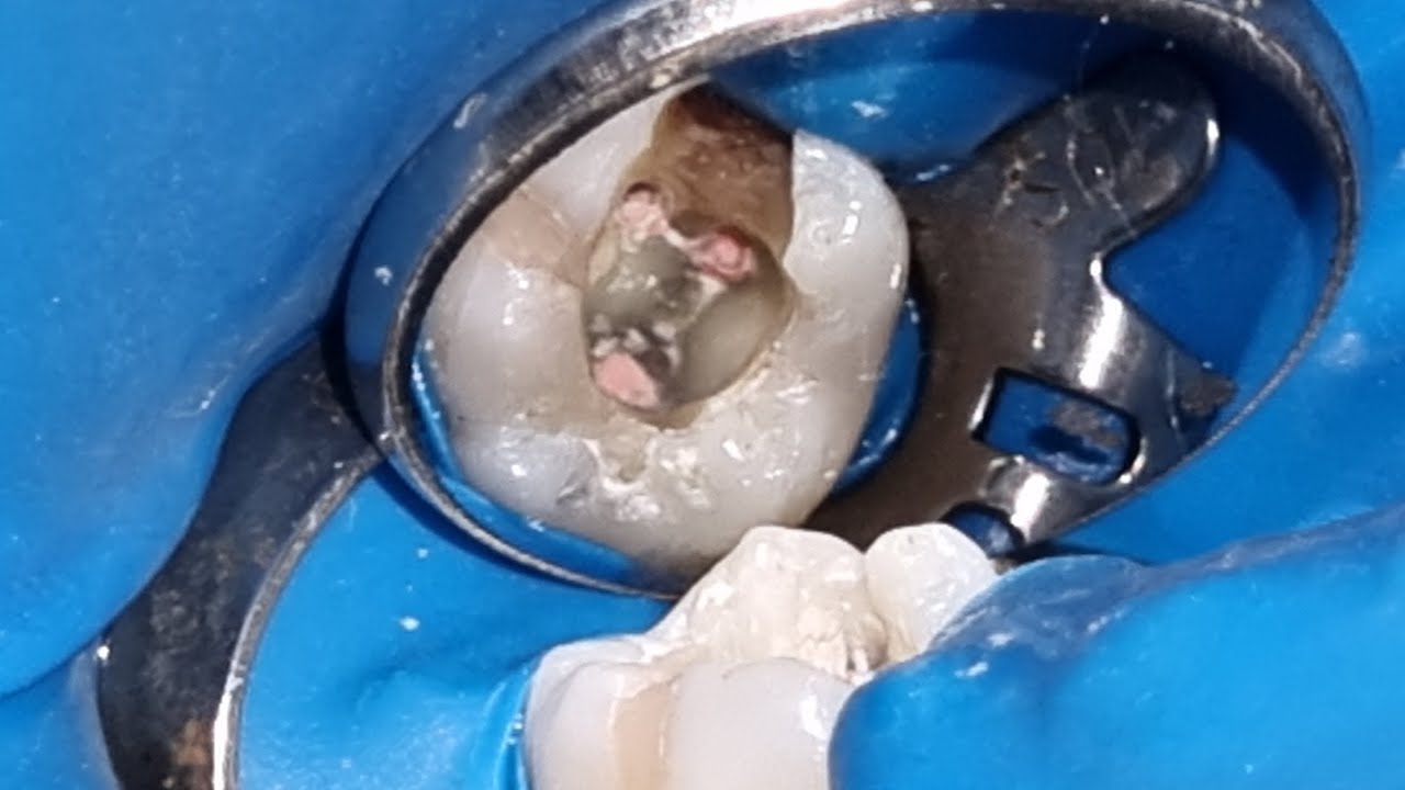 Endodontia Microscópica - dente 46 - YouTube