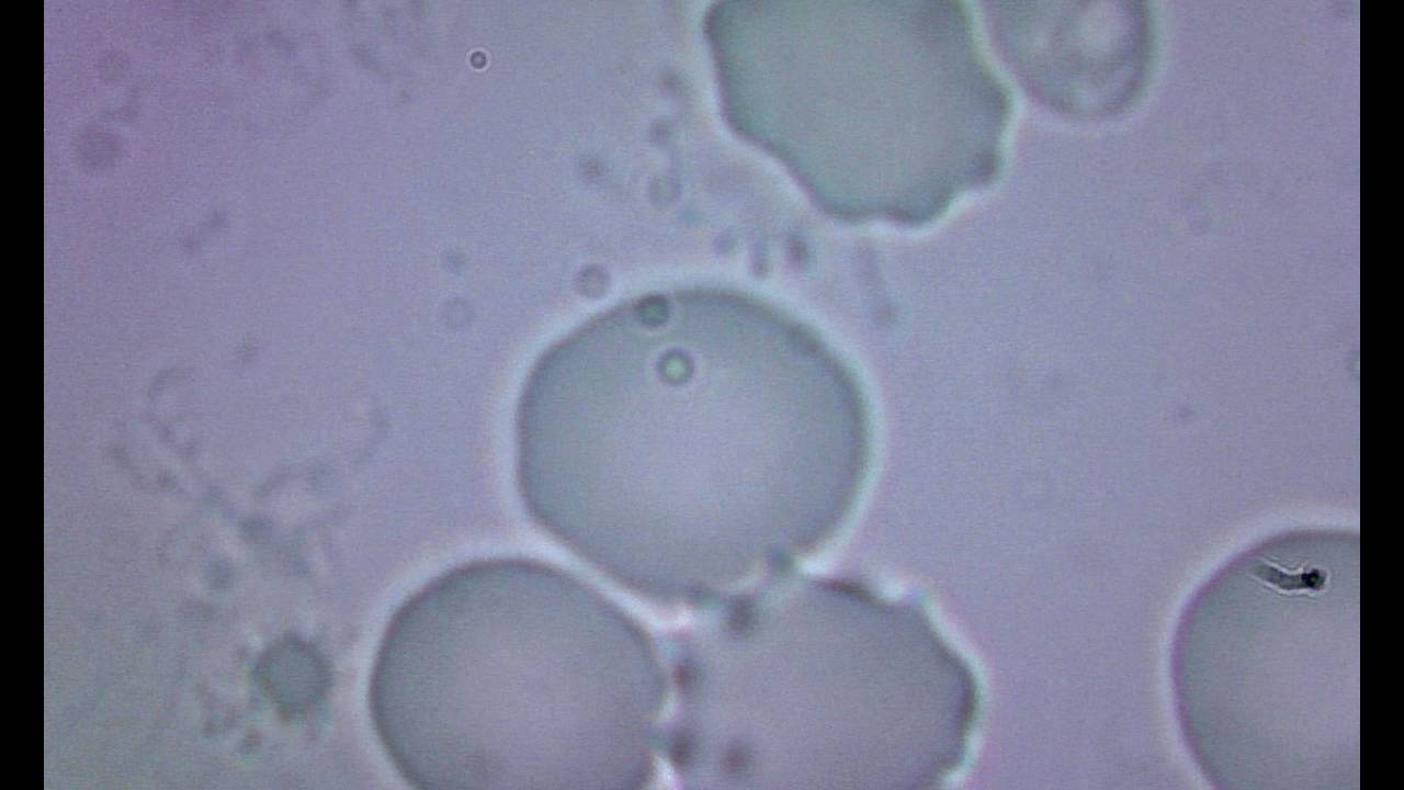Lyme under the microscope 12 - YouTube