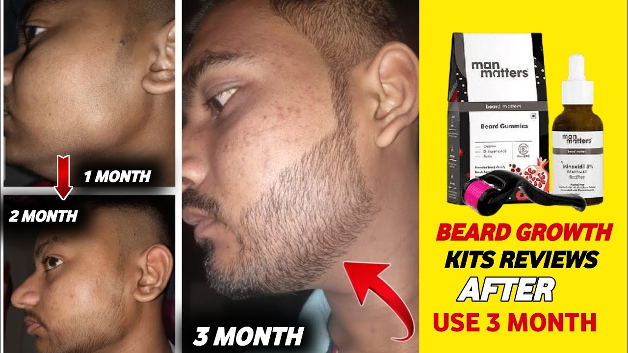Man matters beard growth kit review after use 3 months | beard growth results | minoxidil beard ...