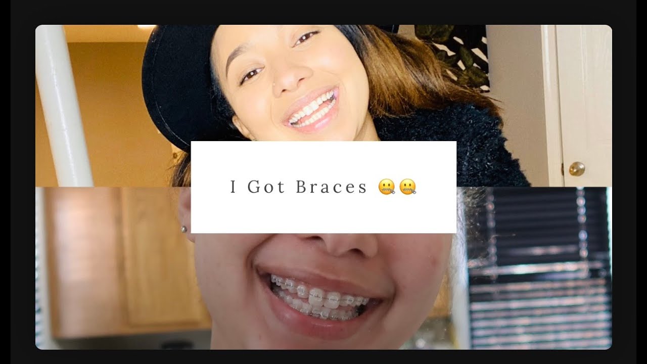 Vlog: GETTING CERAMIC BRACES FOR THE FIRST TIME - YouTube