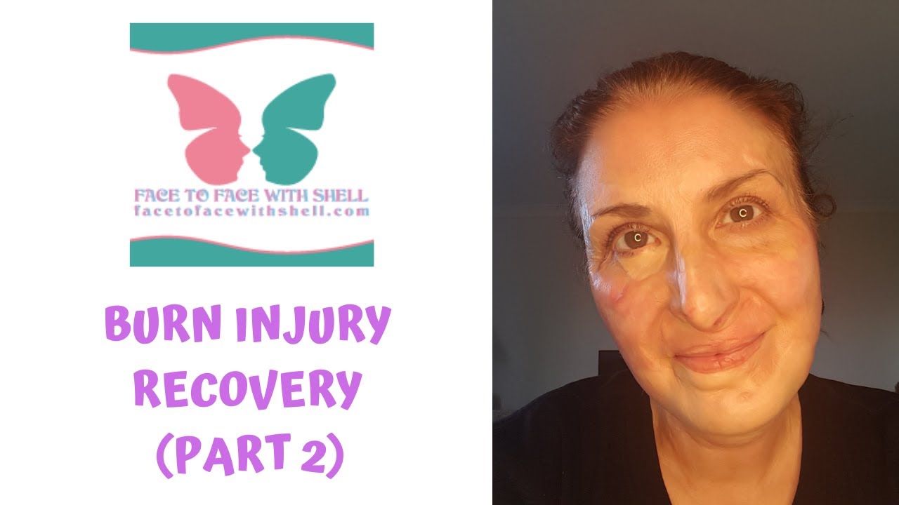 BURN INJURY RECOVERY (PART 2) - YouTube