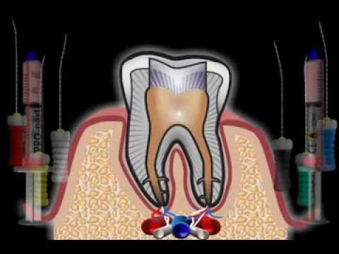 Root Canal Treatment - YouTube