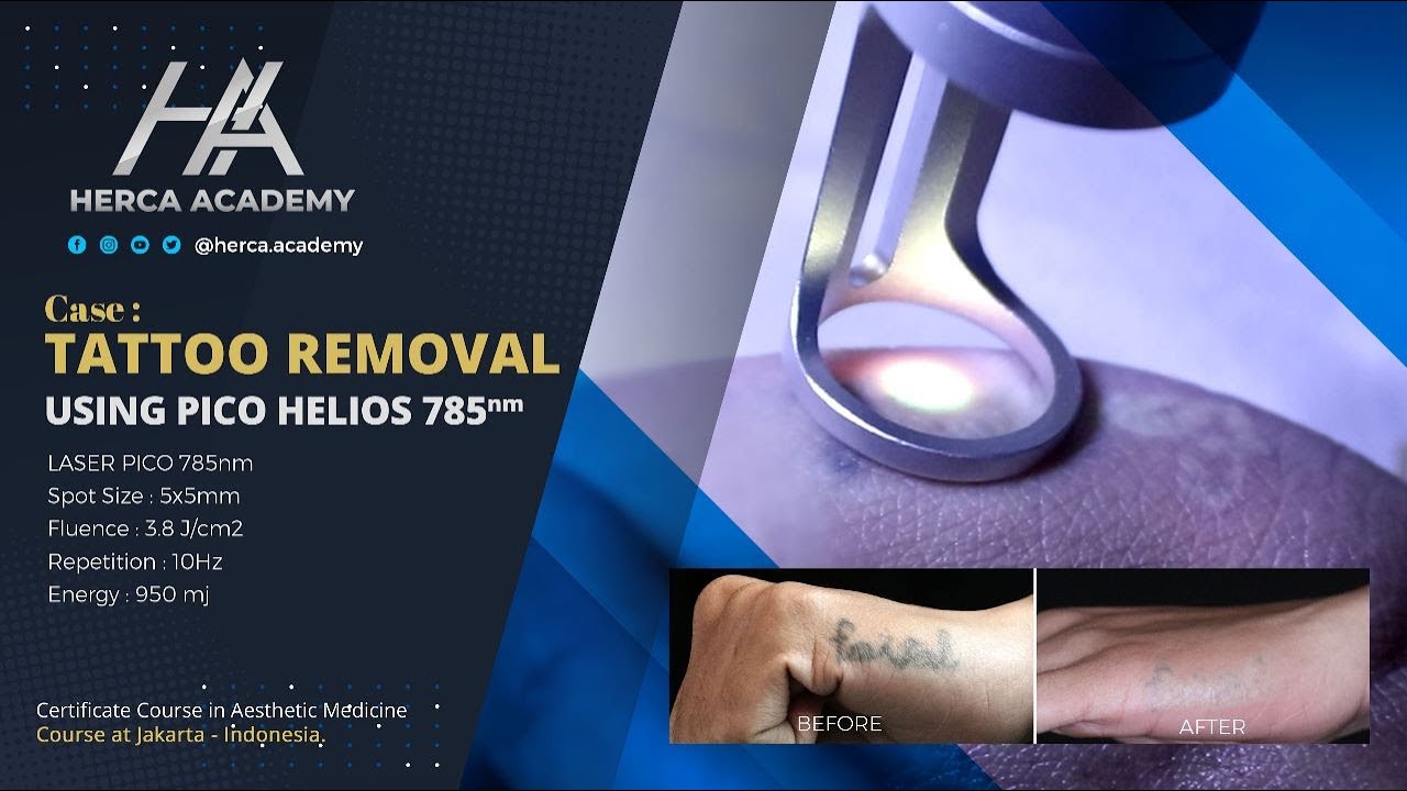 HERCA ACADEMY TEACHING CLASS BASIC LASER BATCH II TATOO REMOVAL USING ...