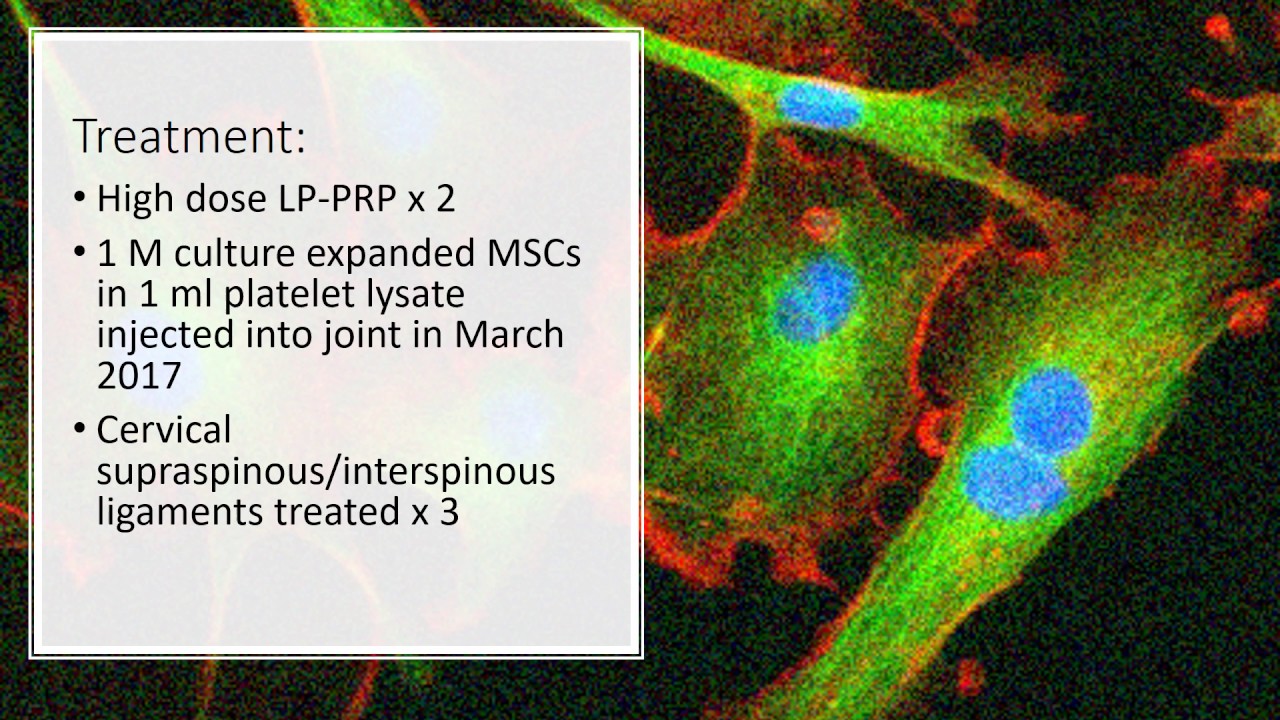 Dramatic Improvement In C2 C3 Facet Joint with Stem Cells - YouTube