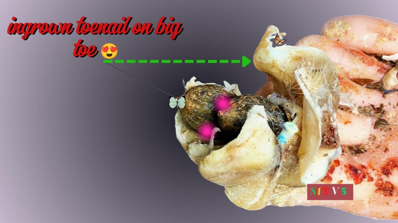 Trim ingrown toenails like horns😭 inverted toenails😭 toenail fungus d.r ...