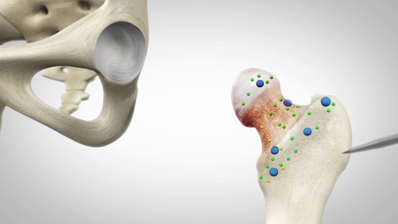 Mako Robotic-Arm Assisted Surgery - Total Hip Replacement | WCH Health ...