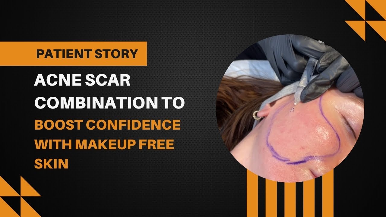 PATIENT STORY | ACNE SCAR COMBINATION TO BOST CONFIDENCE WITH MAKEUP ...