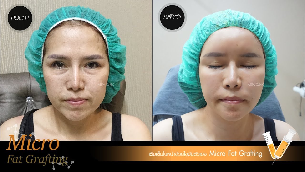 ฉีดไขมัน Micro Fat Grafting โดย อาจารย์หมอนุ่น อทิตาคลินิก Tel. 094-324 ...