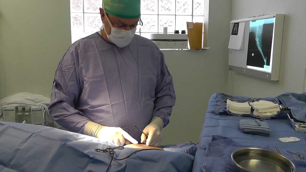 TTA Surgery Video - Video 1 of 13 - YouTube