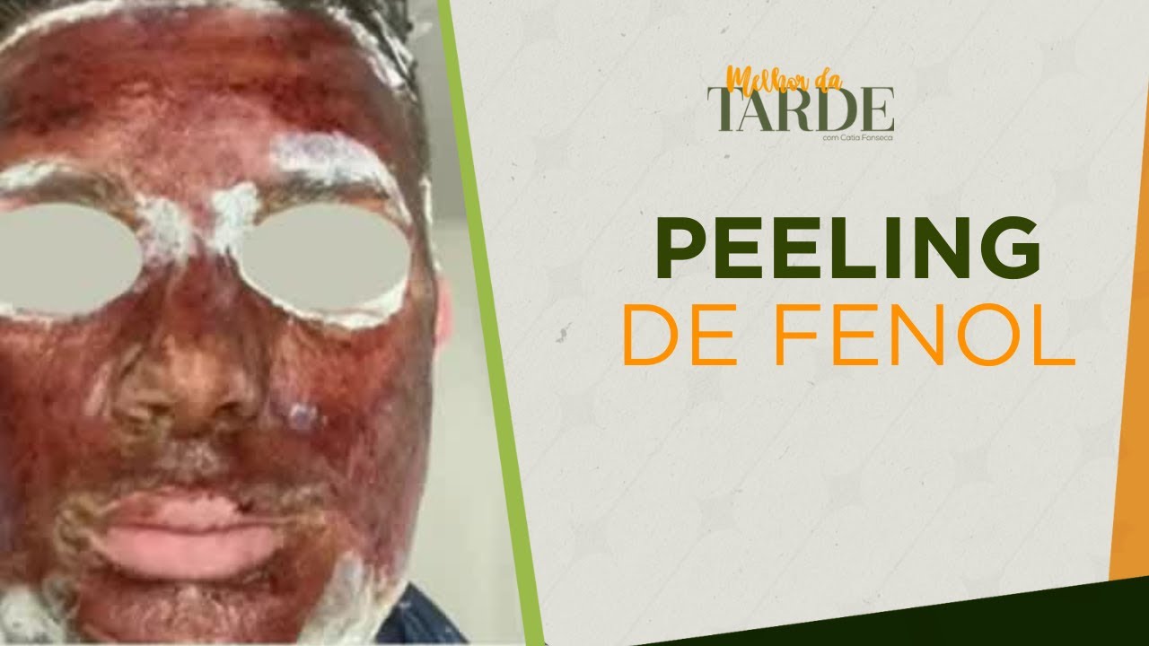 Peeling de fenol: saiba os riscos e os cuidados | Melhor da Tarde - YouTube