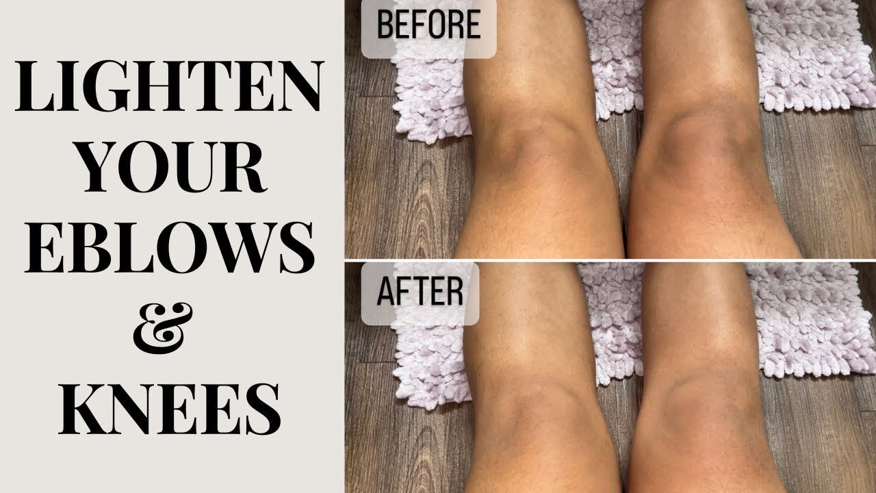 Best Natural Remedies | How To Lighten & Brighten Dark Knees & Elbows ...