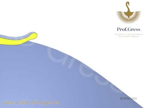 Clitoris Protrusion - Clitoris Correction by Prof. Gress