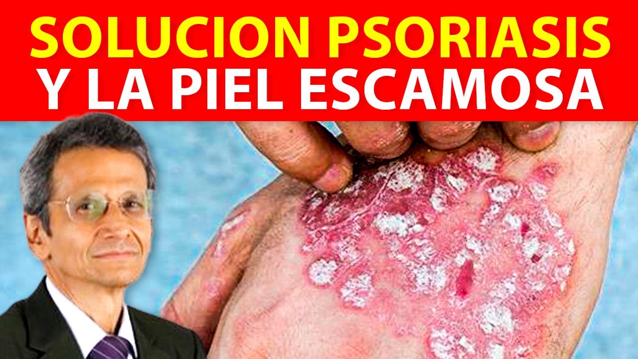 PSORIASIS: Piel Escamosa No más síntomas incontrolables. ¿Qué estás ...