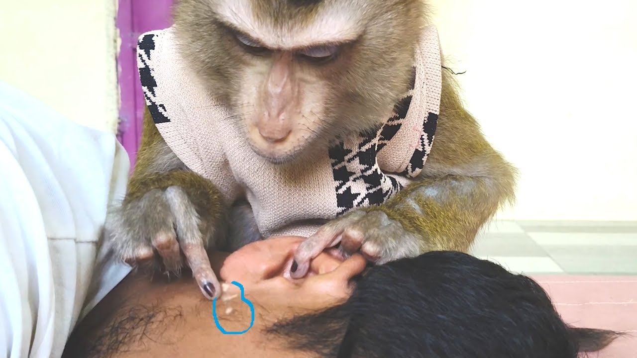 Dr. Bela Professional Method The Safest Way To Remove Large Piece Of ...