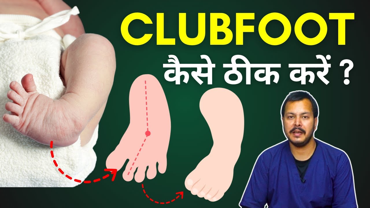 Clubfoot Physiotherapy Treatment, Massage, Exercise - क्लब फुट का इलाज ...