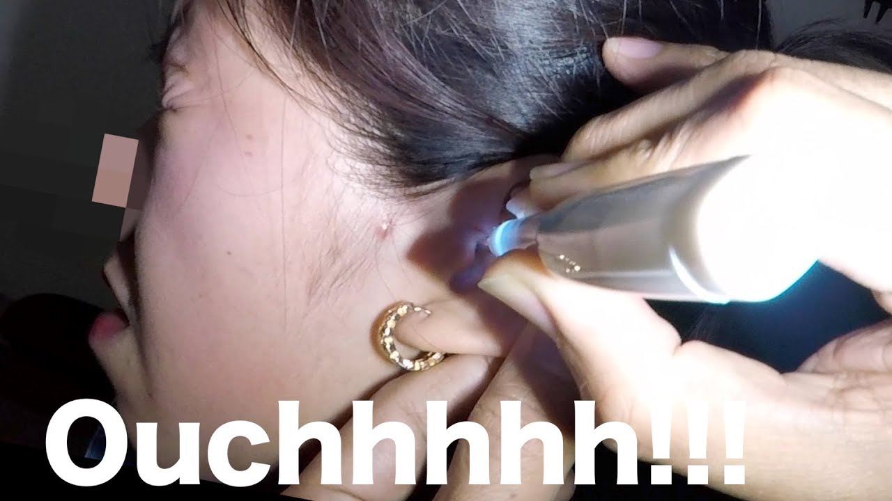 Girl's Complete Earwax Build-up Removal- Now She can hear colors - YouTube