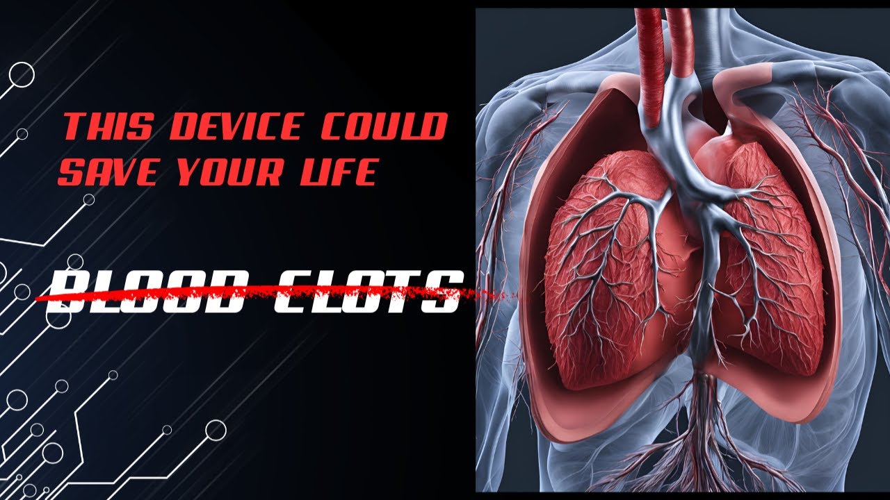 Revolutionary Device to Rescue You from Lung Blood Clots! - YouTube