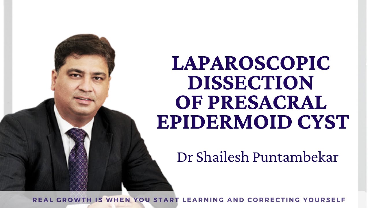LAPAROSCOPIC DISSECTION OF PRESACRAL EPIDERMOID CYST | DR. SHAILESH ...