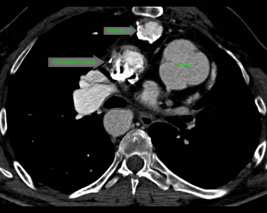 Transposition Great Arteries, UCLA - YouTube