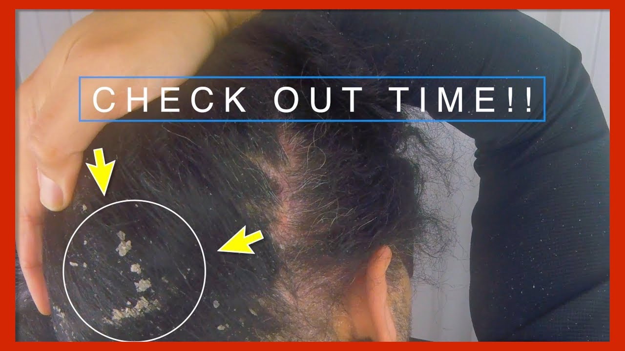 Dandruff be gone! Combing and scratching them out. - YouTube