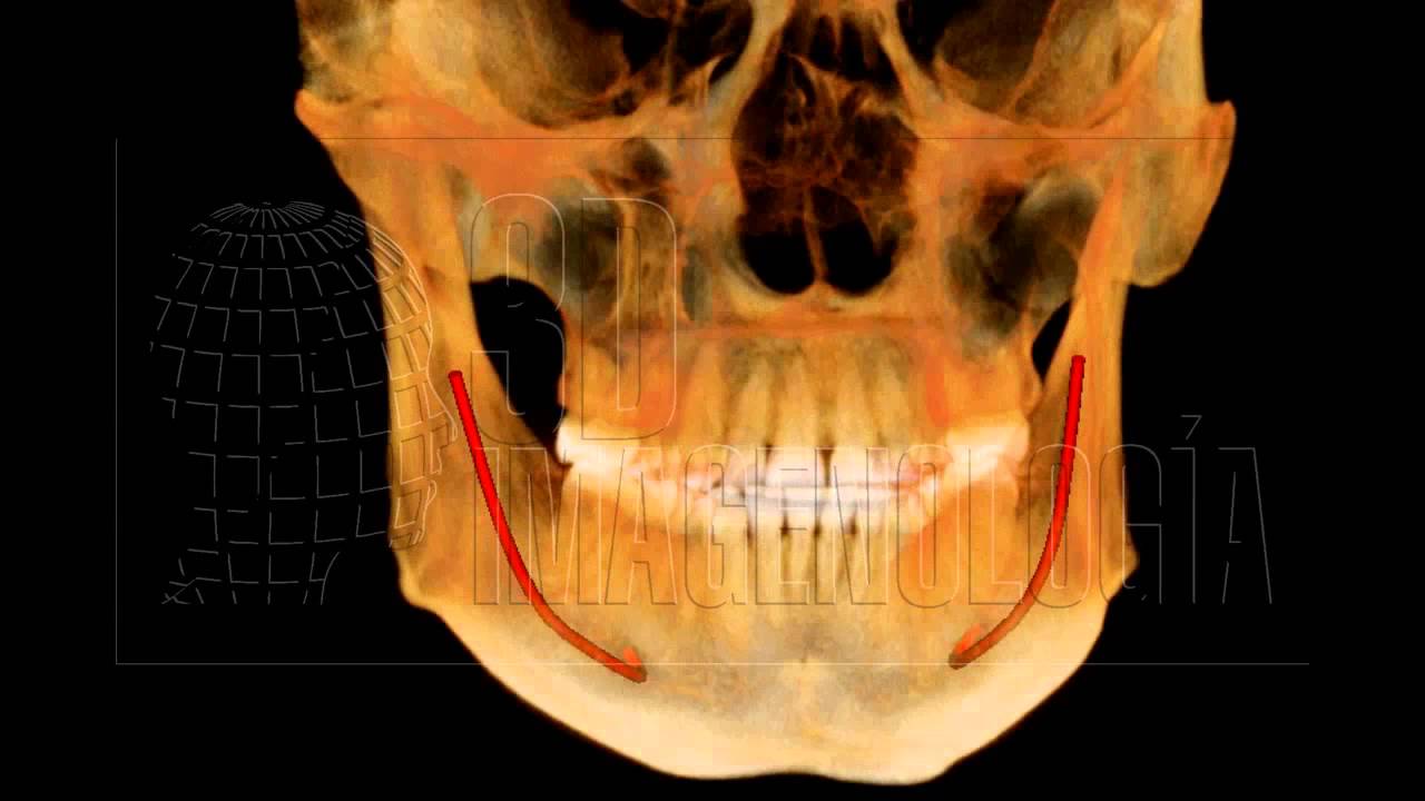 CONDUCTO DENTARIO INFERIOR Y AGUJERO MENTONEANO - YouTube