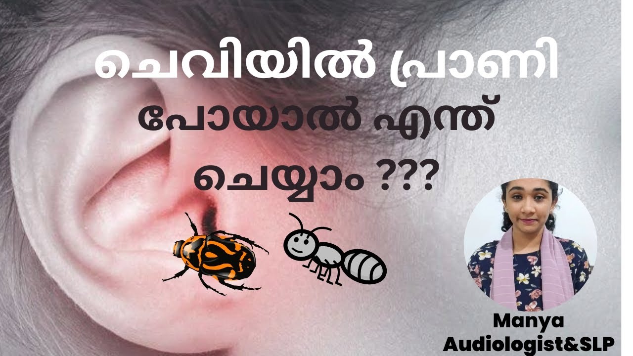Insects in the ear .ചെവിയിൽ പ്രാണി പോയാൽ എന്ത് ചെയ്യണം ?#audiologist # ...