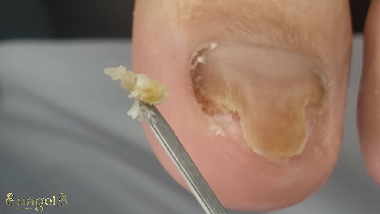 ONICOMICOSE #nails #ingrowntoenail - YouTube