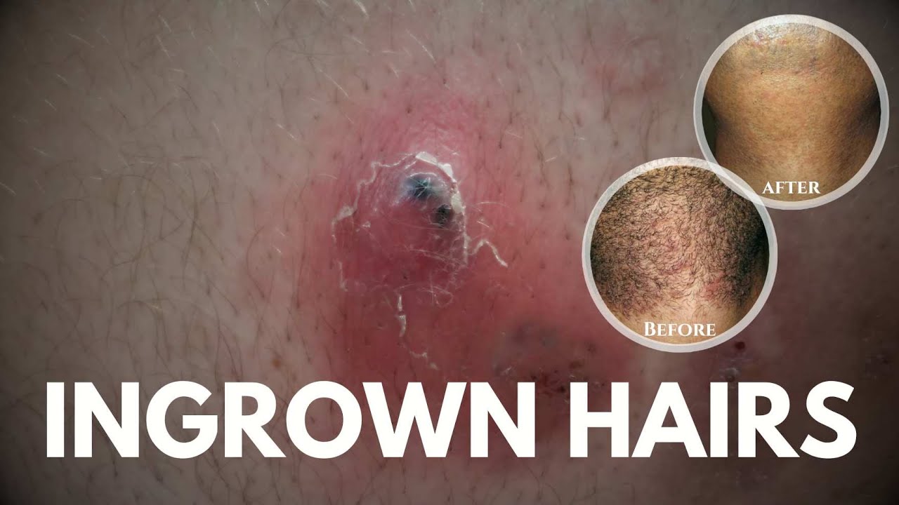 What Are Ingrown Hairs How To Get Rid Of Ingrown Hairs Youtube