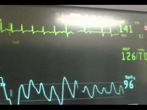 SVT to Sinus Conversion with Adenosine - YouTube