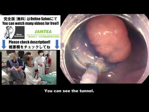 Sample Video ① Colonic ESD -Rectum (Recurrence after EMR) -by Ohata ...