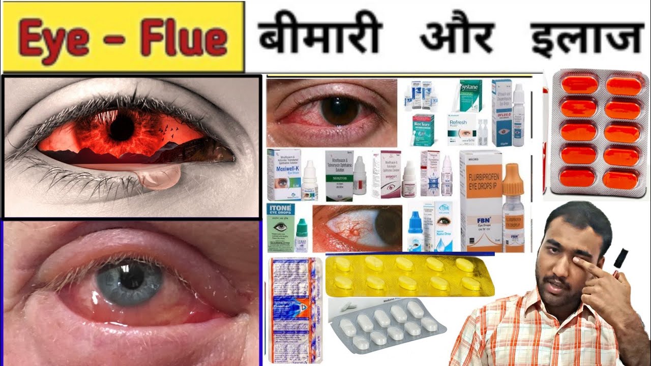 Eye Flue ।। Conjunctivitis Infection ।। Treatment and Symptoms ...