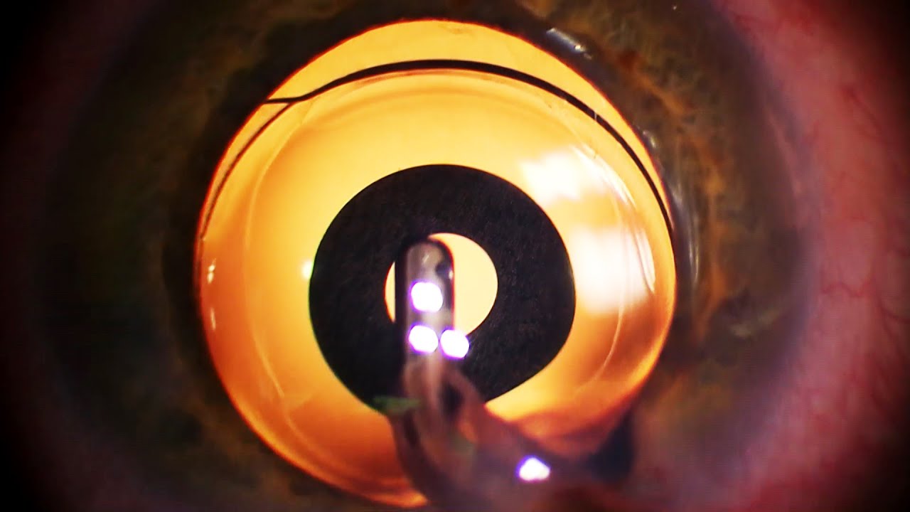 Cataract Surgery with small aperture Intraocular Lens Apthera IC-8 for ...