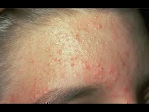 Acne Signs and symptoms - YouTube