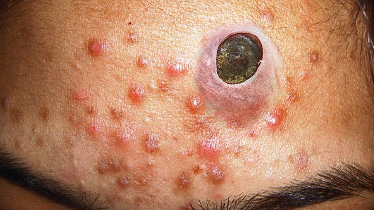 Forehead Blackheads Dark Black Gorehead Warning Photoshop forehead-blackheads-dark-black-gorehead-warning-photoshop